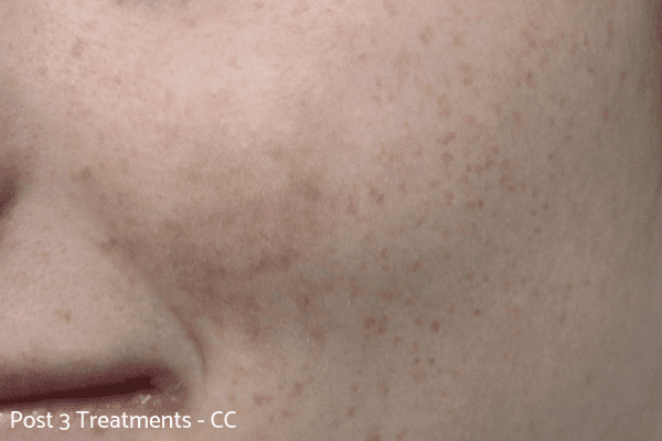 Laser Skin Treatments Sydney - Clean Canvas Laser Clinic